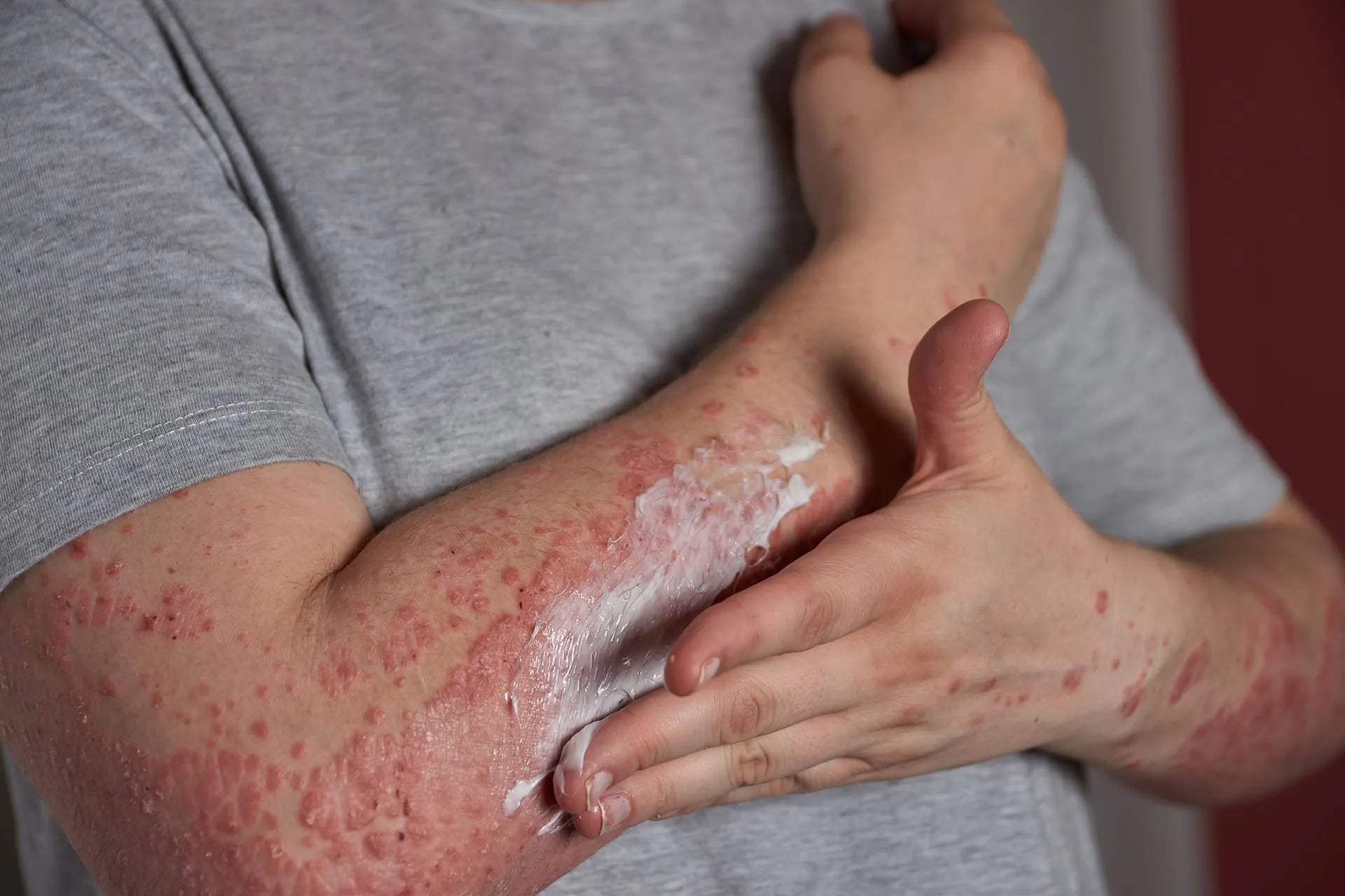 What Is Textile Dermatitis? Causes & Treatment | SoteriSkin